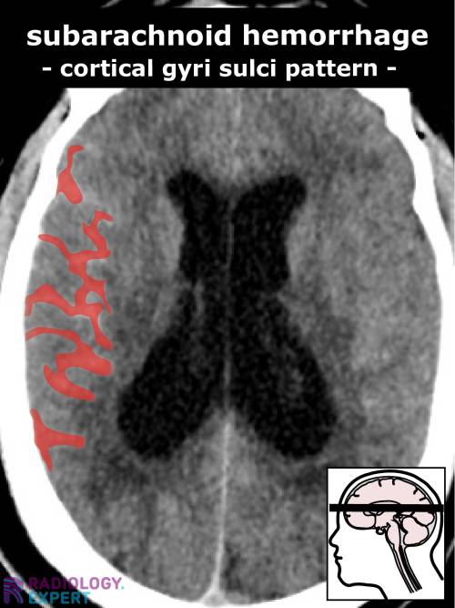 CT brain hemorrhage